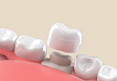 Crowns | Inchvannie House Dental Practice